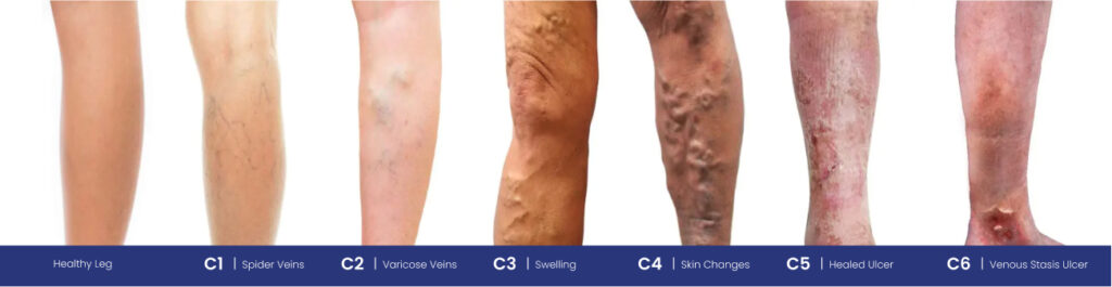 Chronic Venous Insufficiency - Cape Town Vascular