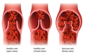 Chronic Venous Insufficiency - Cape Town Vascular